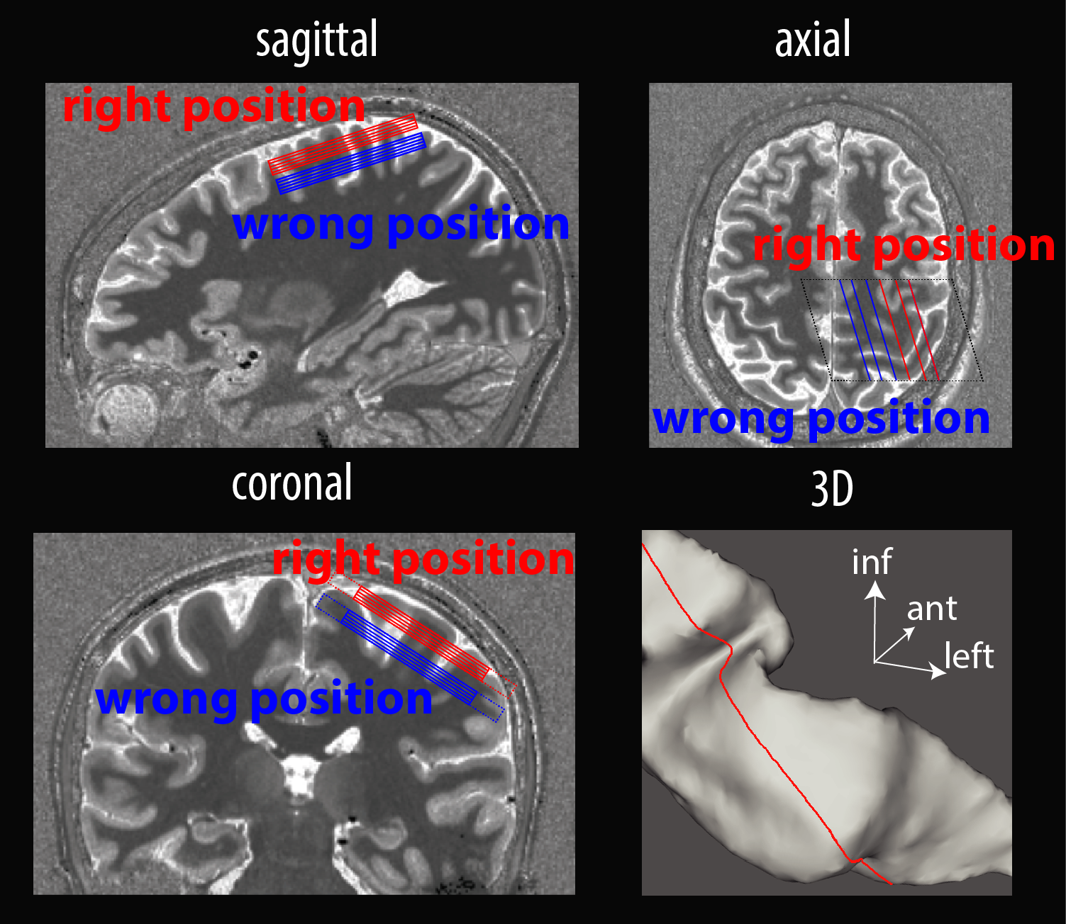 Finding ROI of the double layers in M1 – layer fMRI blog