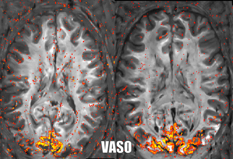 SS-SI VASO pitfalls in visual cortex – layer fMRI blog